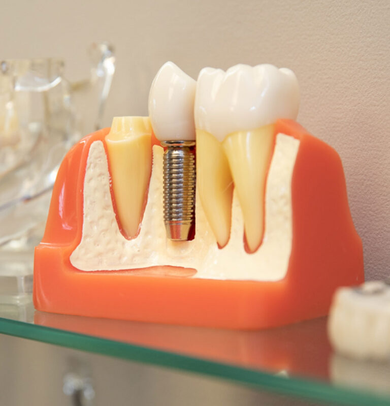 Dental Implants - Fixed Arch | Advanced Dental Implant Center