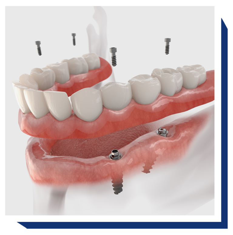 Dental Implants in Denver CO | Advanced Dental Implant Center